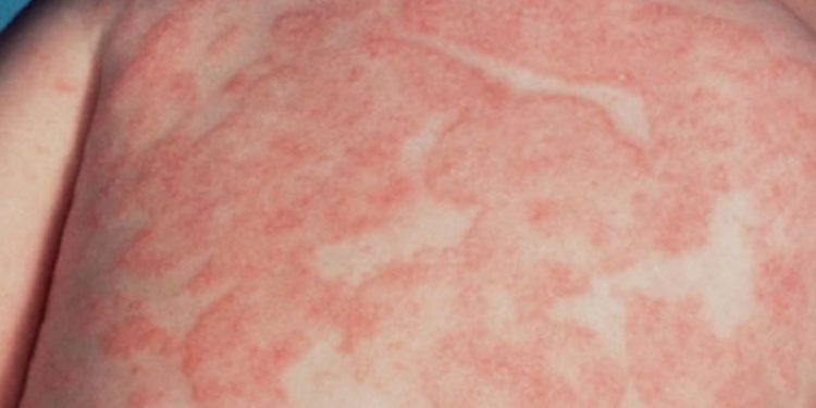 Photodermatosis - Definition of Photodermatosis