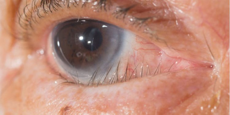 Trichiasis - Definition of Trichiasis