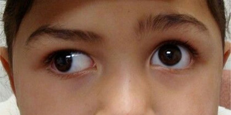 Wall eye - Definition of Wall eye