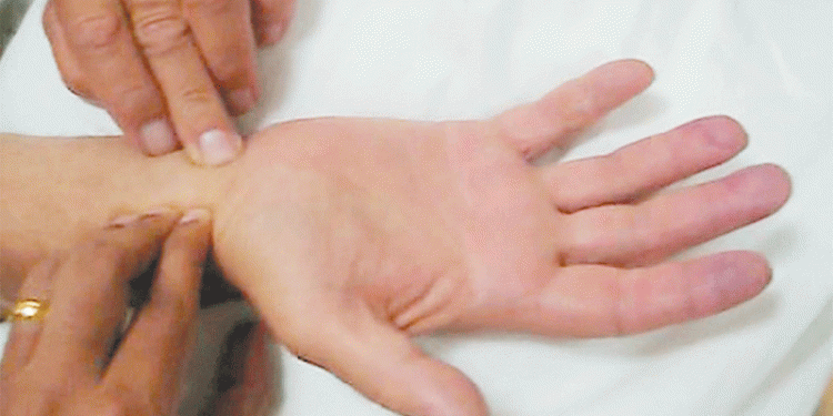 Allen test - Definition of Allen test