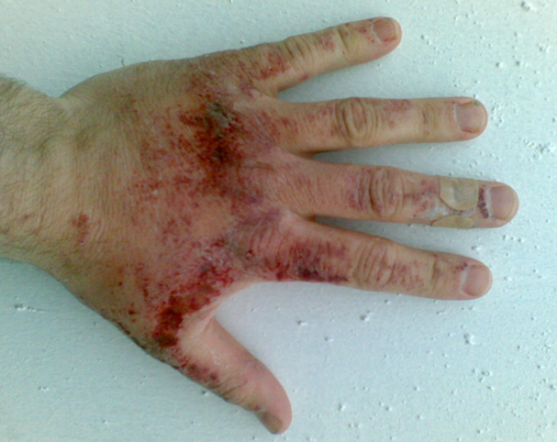 Chemical Burns Definition Of Chemical Burns Chemical Burns Definition Of Chemical Burns