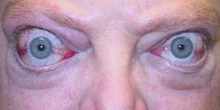 Eye graves disease - Definition of Eye graves disease