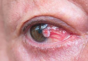 Eye tumors - Definition of Eye tumors