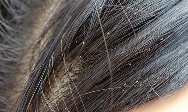 Head lice - Definition of Head lice
