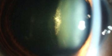 Posterior subcapsular cataract - Definition of Posterior subcapsular ...