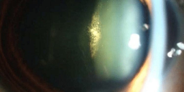 Posterior subcapsular cataract - Definition of Posterior subcapsular ...