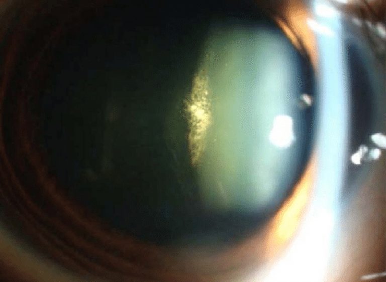 Posterior subcapsular cataract - Definition of Posterior subcapsular ...
