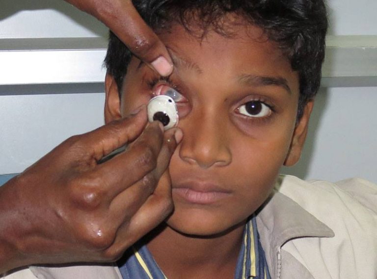 Prosthetic eye - Definition of Prosthetic eye