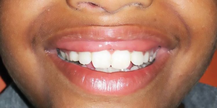 Double lip - Definition of Double lip